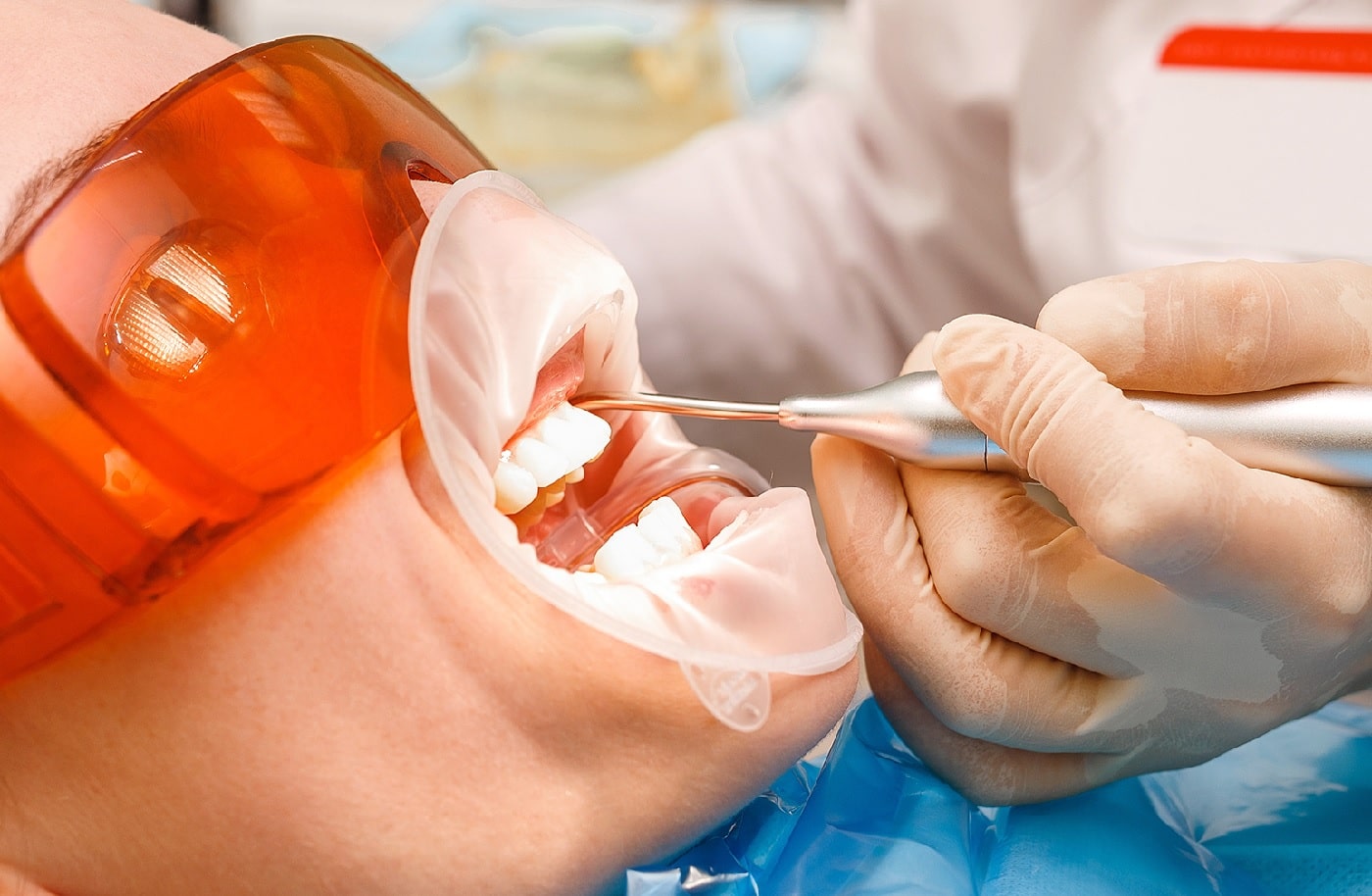 Diş Taşı Temizliği: Nasıl Yapılır? Yöntemler Nelerdir?